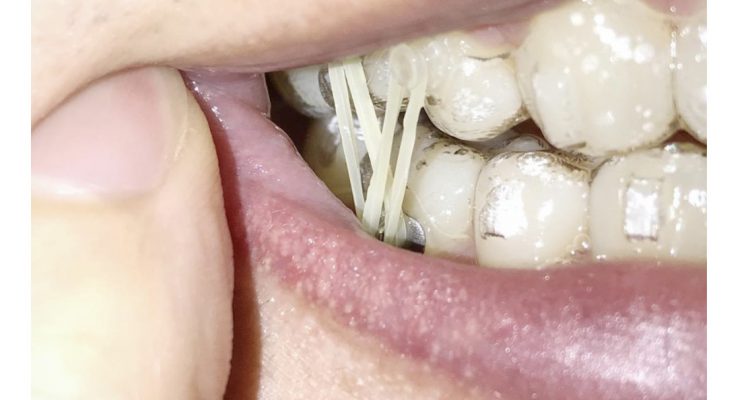 Invisalign Rubber Band | PuPe_So_Sweet